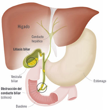 Cálculo biliar o piedras en la vesícula - El Castillo de San Fernando ...